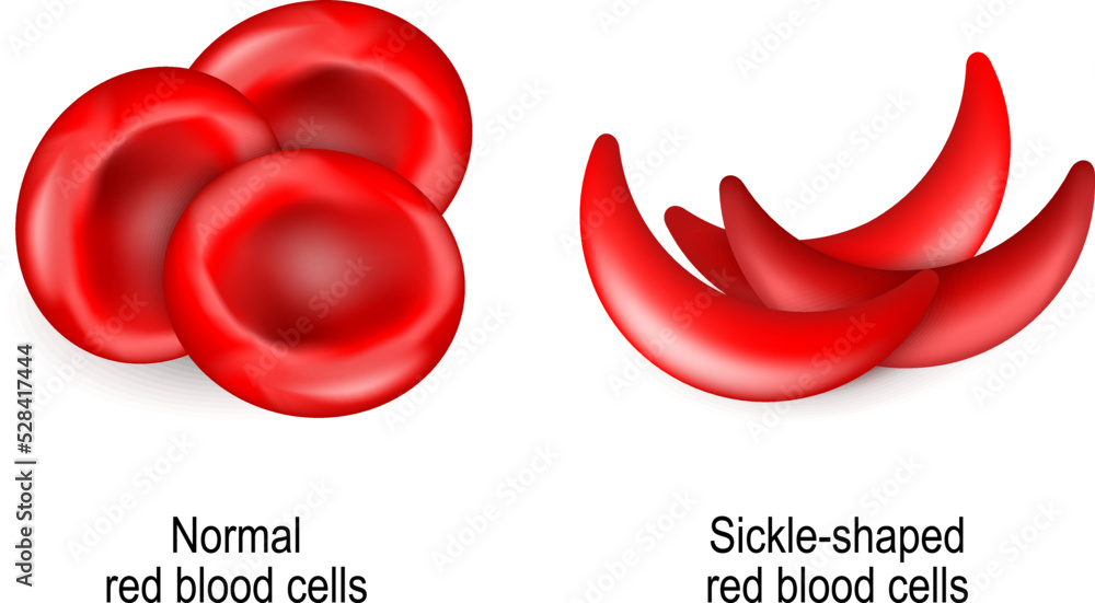 Photo & Art Print normal erythrocytes and sickle-shaped red blood cells ...