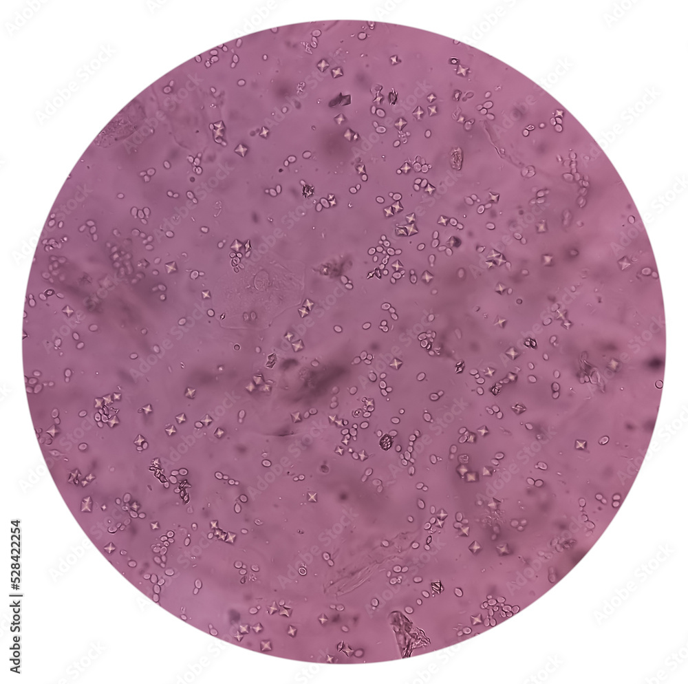 Budding yeast cells and calcium oxalate crystal in urine, urinary tract ...