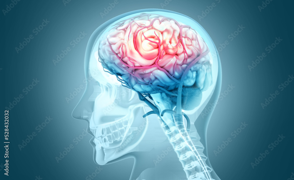 Human brain injury,damage,hemorrhage. 3d illustration Stock ...