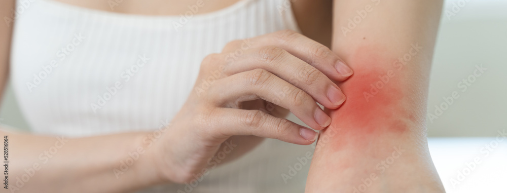 Sensitive skin allergic concept, Woman itching on her arm have a red ...