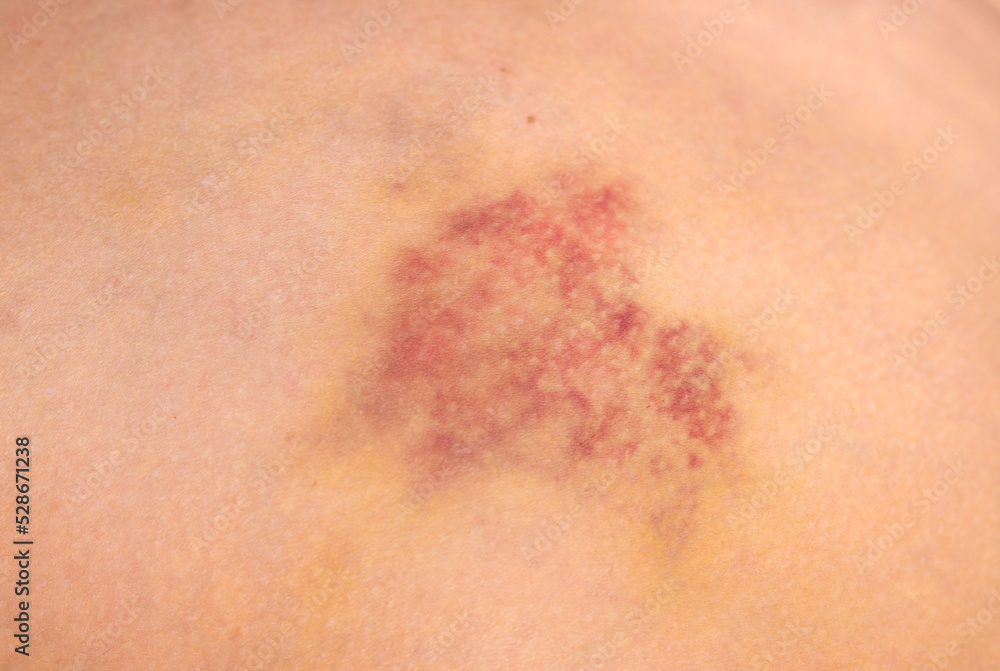 Bruises on the human body. Severe bruise from impact, bruising and ...