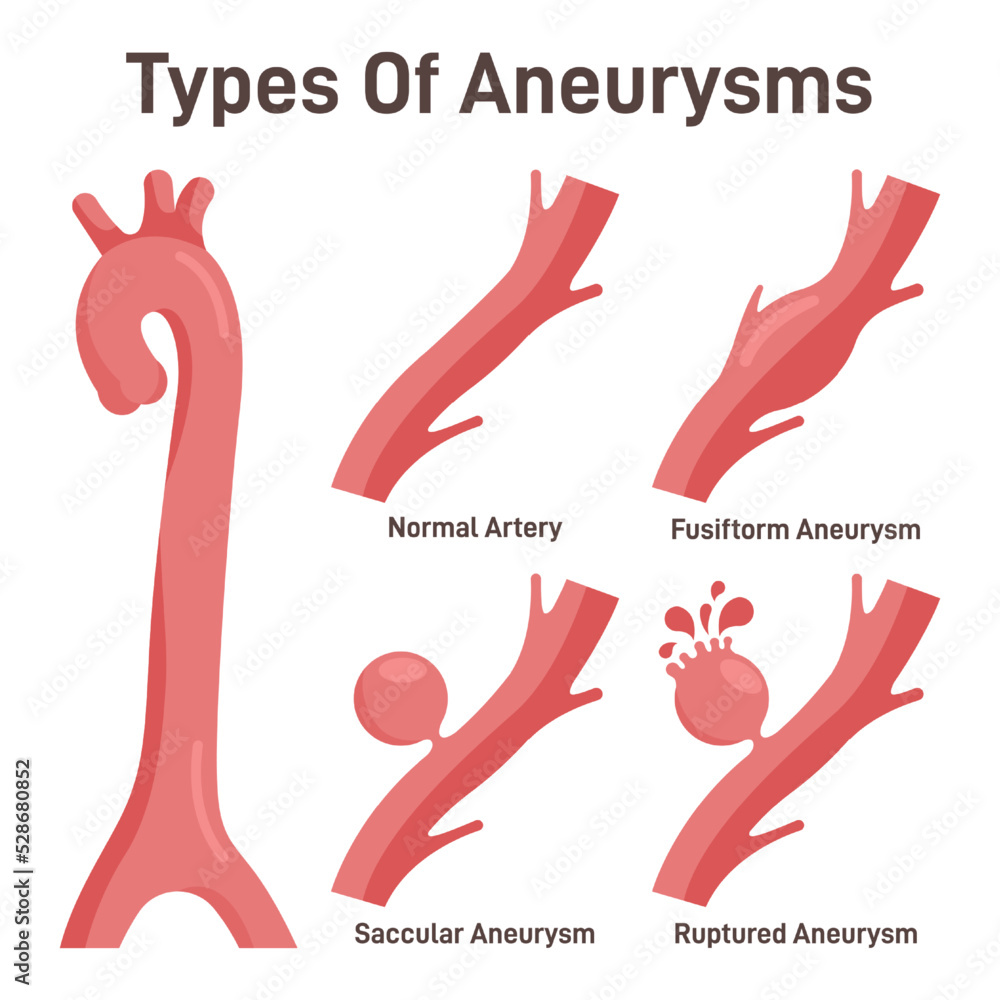 Poster Thoracoabdominal aortic aneurysms types. Healthy aorta and aorta ...
