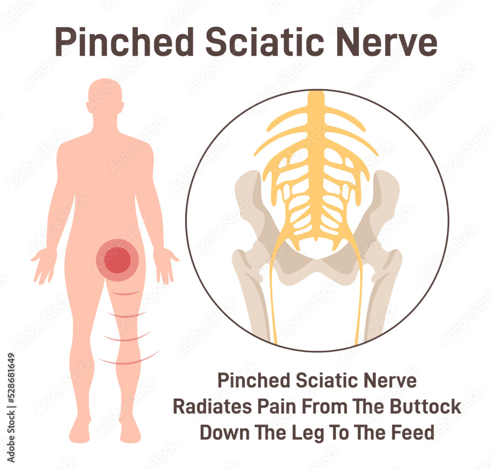 Sciatica. Pinched sciatic nerve causing pain and inflammation in pelvis Stock Vector | Adobe Stock