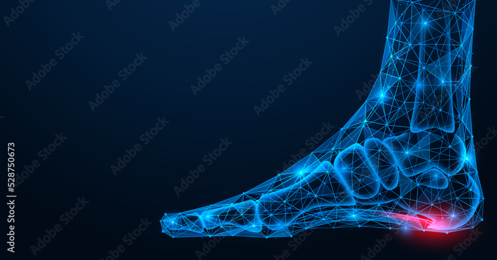 Heel spur, injury to the plantar ligament of the leg. Polygonal design ...