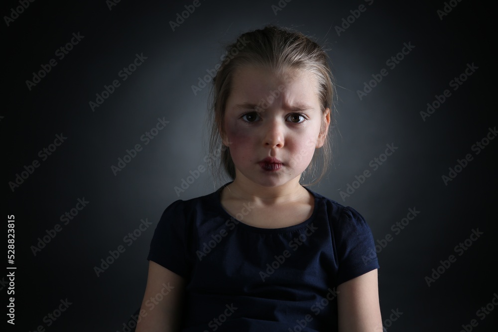 Little girl with bruises on face against dark background. Domestic ...