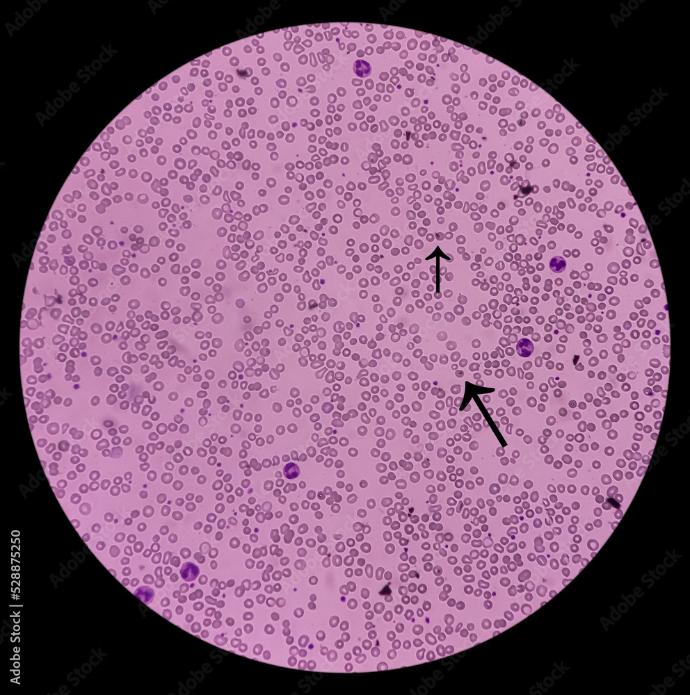 Blood smear show target cell and spherocytes. Hereditary spherocytosis ...