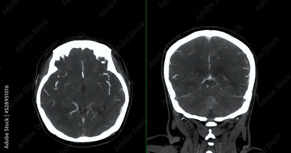 CTA brain or Computed tomography angiography of the brain comparison ...