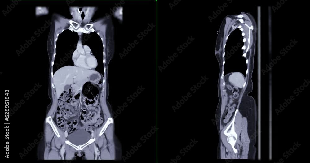 CT Chest and whole abdomen with contrast media coronal and sagittal ...