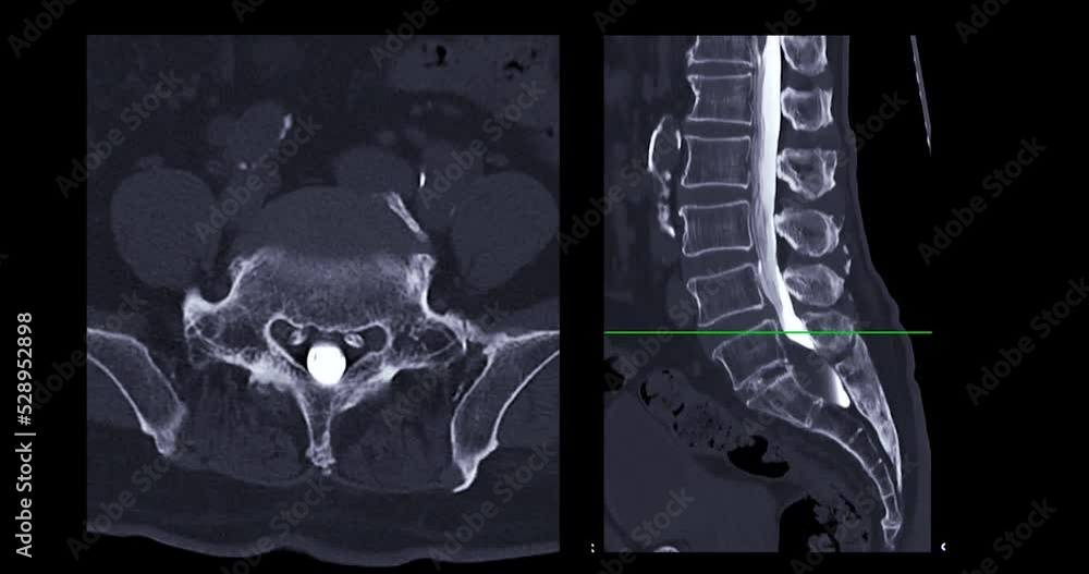 CT myelography or myelogram from computed tomography (CT-scanner) to ...