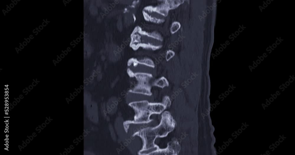 CT myelography or myelogram from computed tomography (CT-scanner) to ...