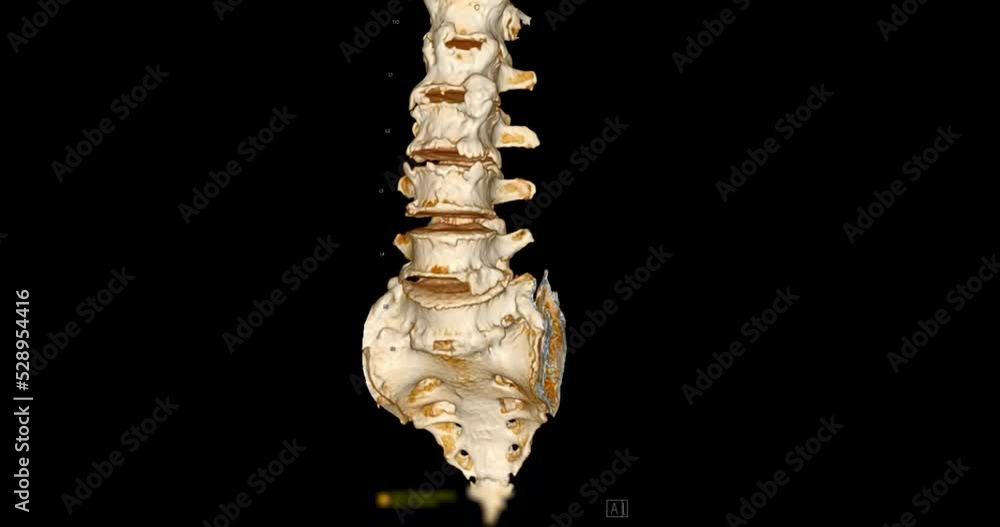 CT Scan of lumbar spine for diagnosis backache diseases.3D rendering ...
