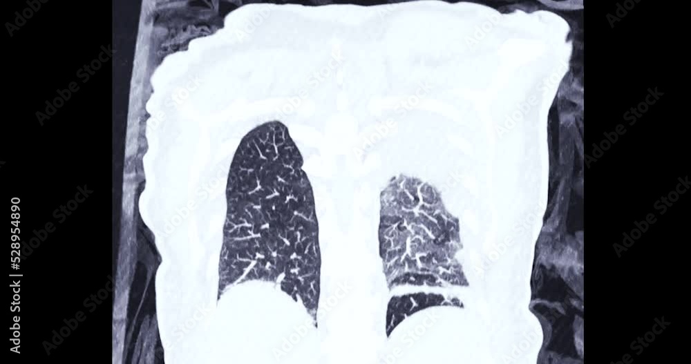 CT Chest or CT Scan of Lung Coronal MIP View for diagnosis TB,tuberculosis and coronavirus or ...