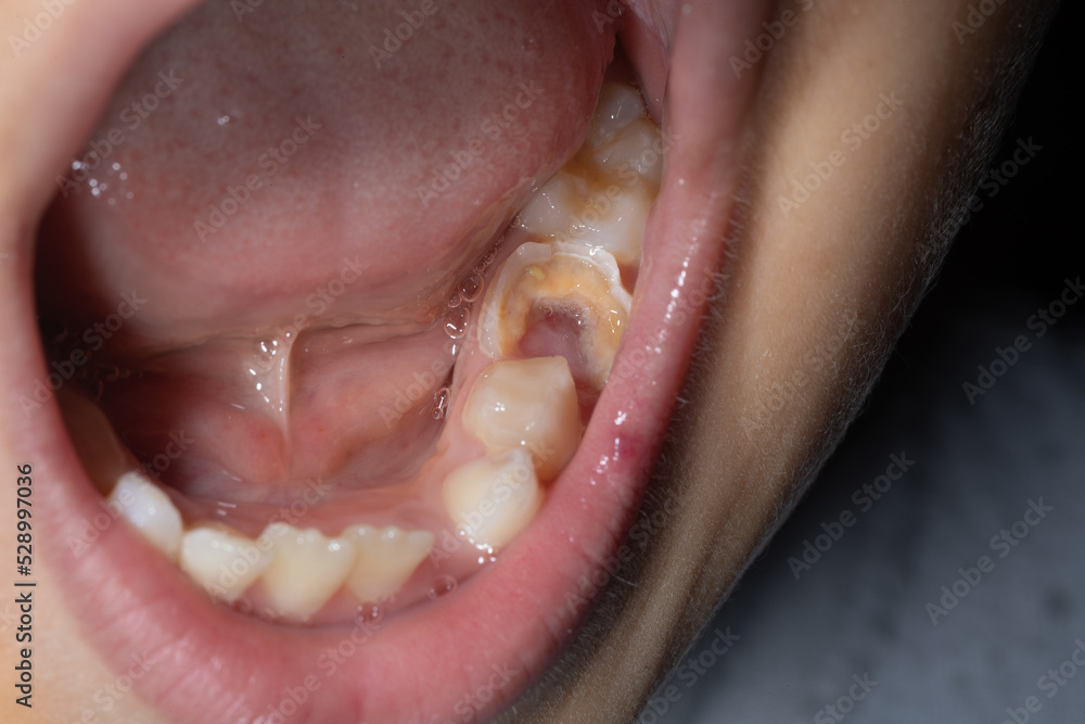 Destruction of a tooth by dental caries and disease Stock Photo | Adobe ...