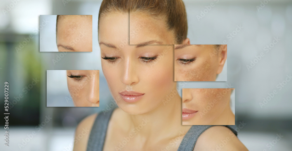 Dark spots, freckles,hyperpigmentation(melasma or chloasma),concept ...