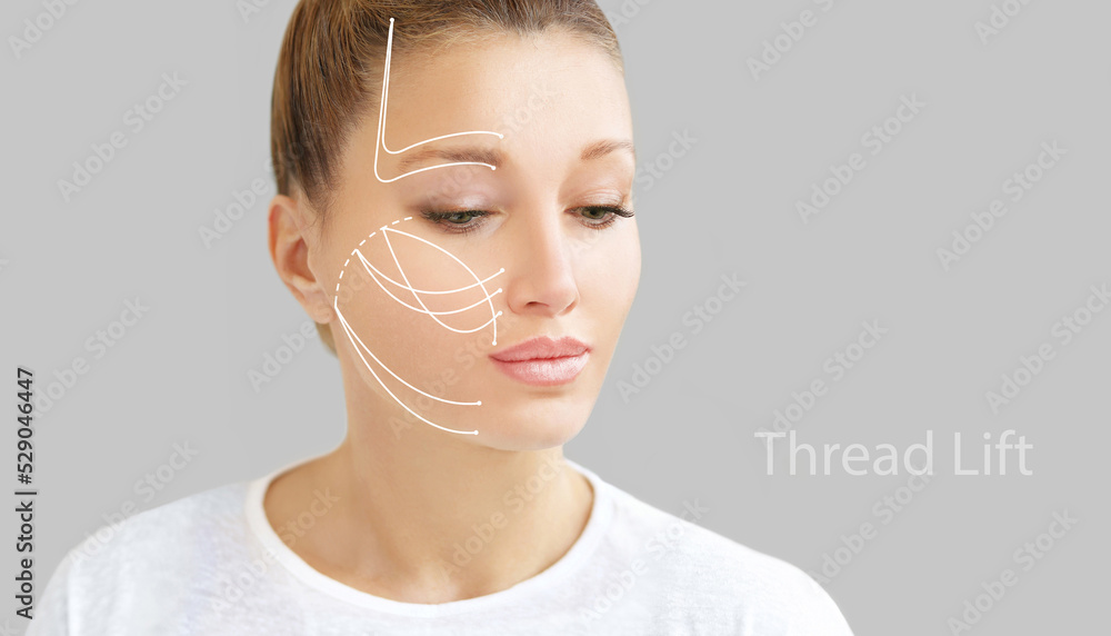 Thread Lift ,markup,technique for performing nonsurgical lifting ...