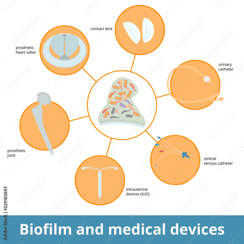 Biofilm and medical devices. Common sources of biofilm growth and ... Biofilm and medical devices. Common sources of biofilm growth and ...