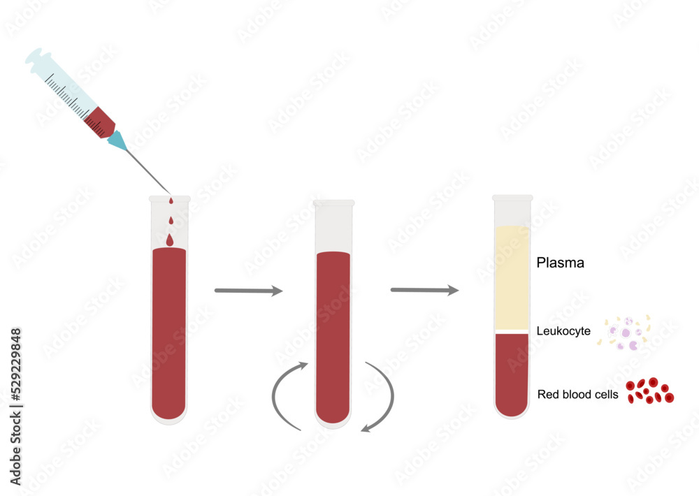 The peripheral or whole blood were centrifuged and separated the ...