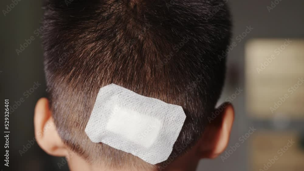 The lacerated suture wound of kid back head which suture with trauma ...