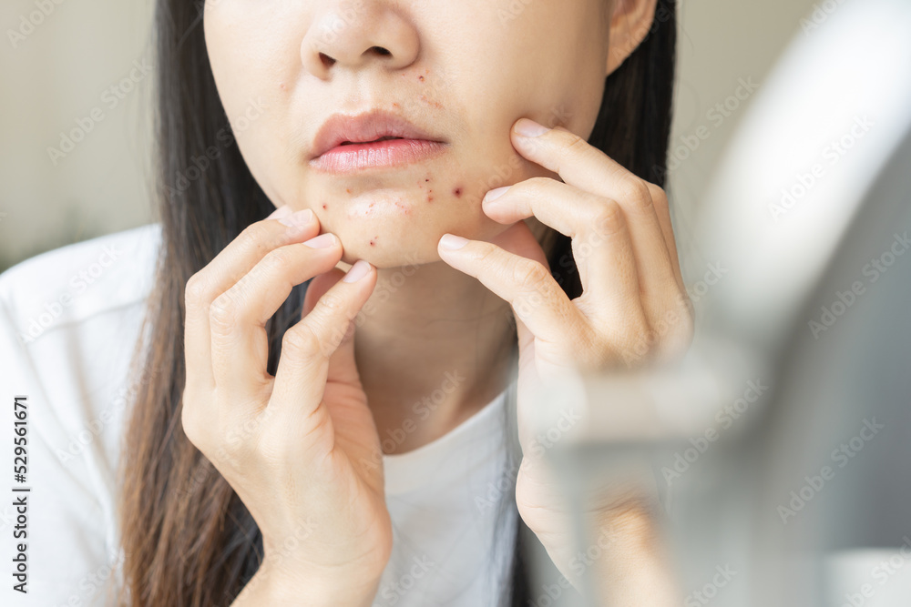 Expression worry asian young woman hand touching pustule around the ...