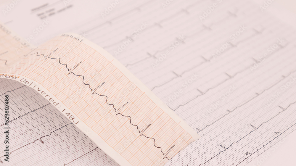 ekg paper showing ECG results on a white background Stock Photo | Adobe ...