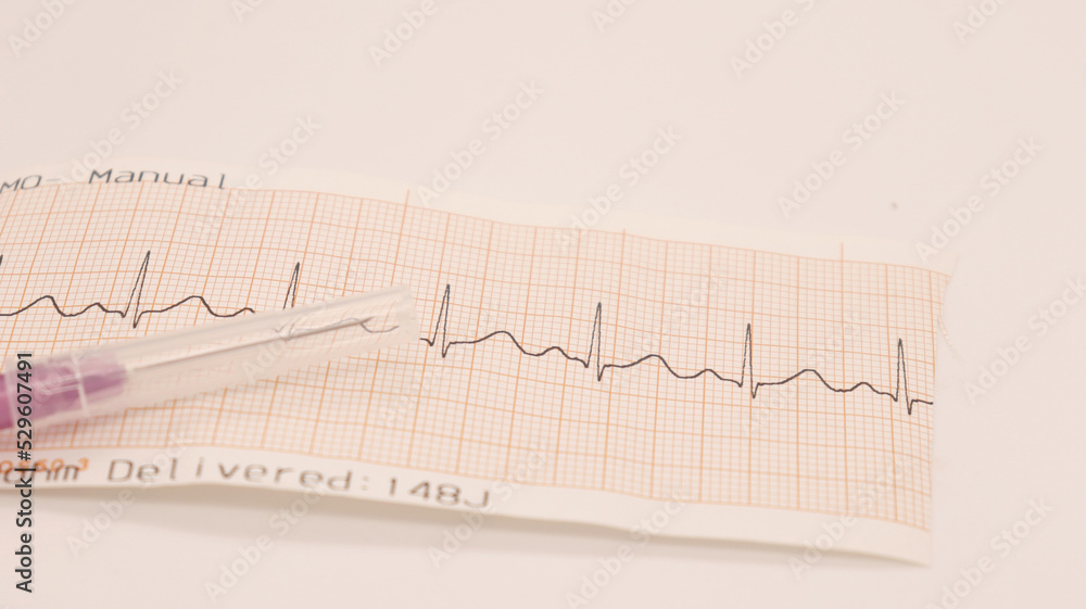 ekg paper showing ECG results on a white background Stock Photo | Adobe ...