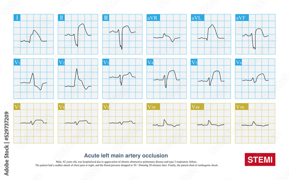 Acute left main artery occlusion can cause both ST segment elevation ...