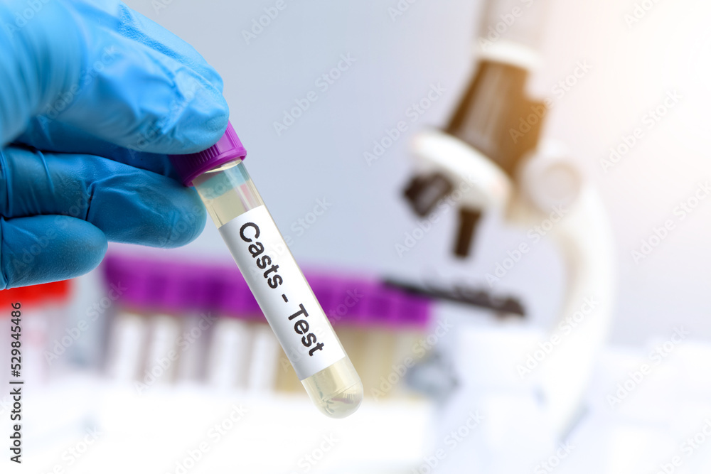 Urine samples for testing Casts in the laboratory Stock Photo | Adobe Stock