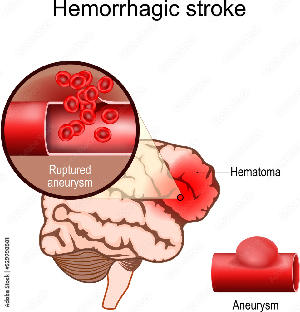 Hemorrhagic stroke. Human brain with Hematoma Stock Vector | Adobe Stock