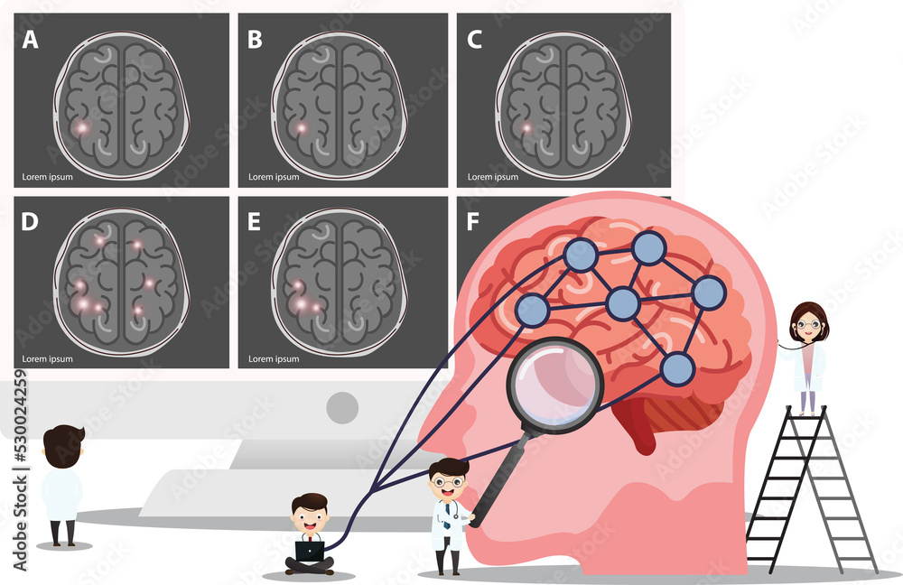 Hemorrhagic brain stroke concept. Apoplexy, cerebral hemorrhage ...