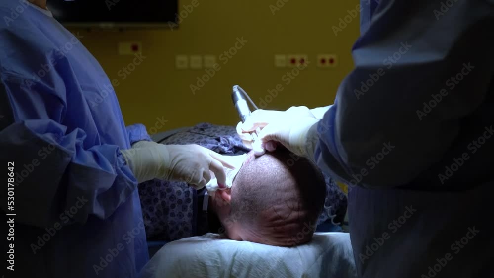 hair transplant surgery for balding man in hospital with dhi pencil ...