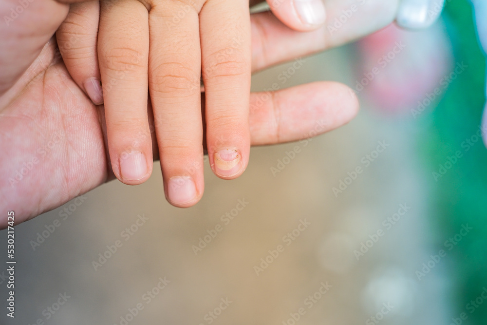 Mechanical damage to the nail plate. Nail Changes Occurring Secondary ...