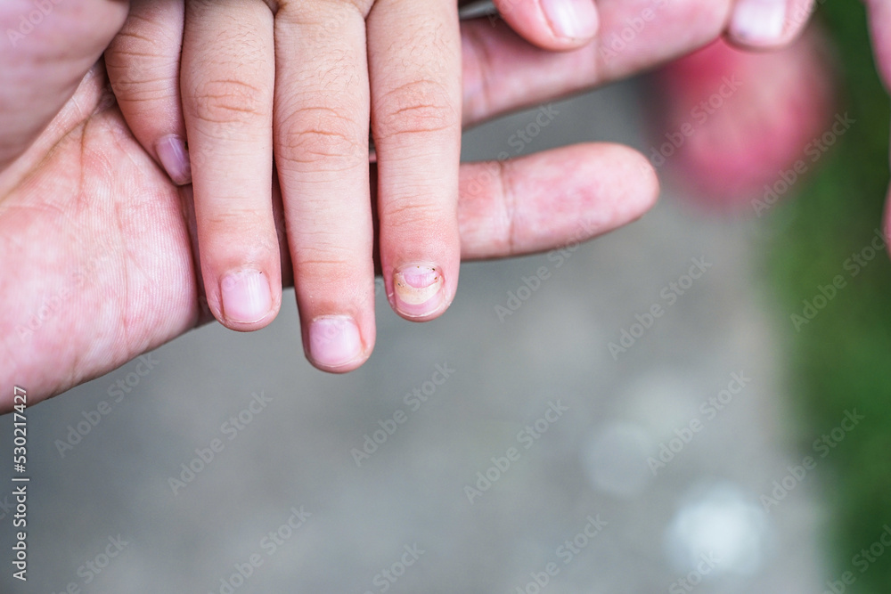 Mechanical damage to the nail plate. Nail Changes Occurring Secondary ...