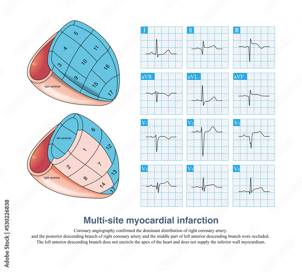 Male, 36 years old, admitted to the hospital with chest pain for 1 day ...