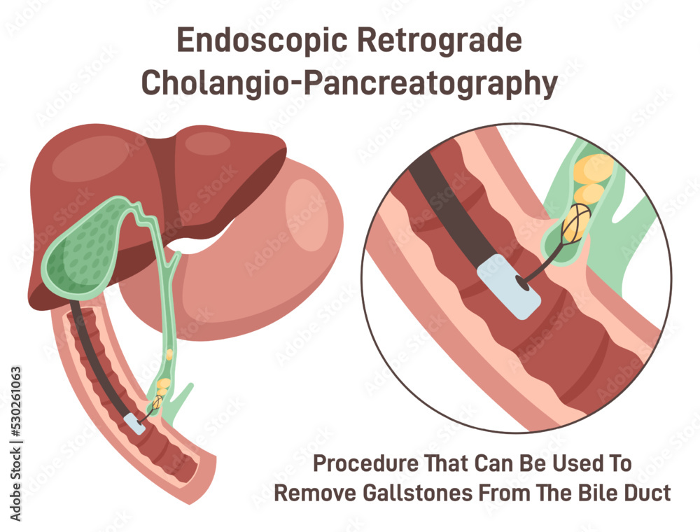 Endoscopic Retrograde Cholangiopancreatography Ercp Bile Duct