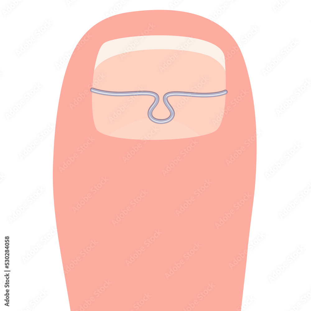 Thumb with a titanium staple for correction of the shape of the toenail ...