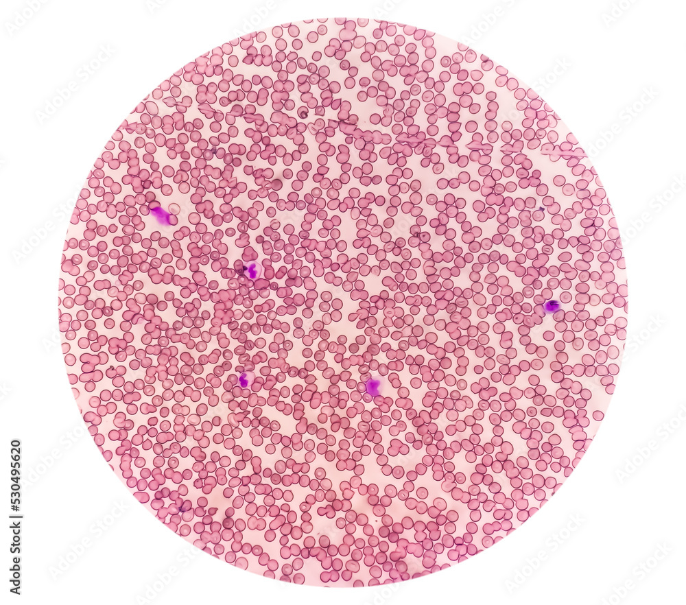 Microscopic view of hematological stained slide. thrombocytopenia ...