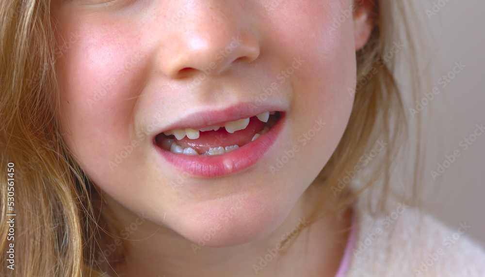 A close-up of the smile of a little girl without milk teeth, with ...