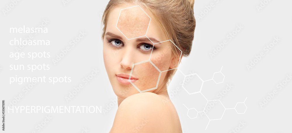 Dark spots, freckles,hyperpigmentation(melasma or chloasma),concept ...
