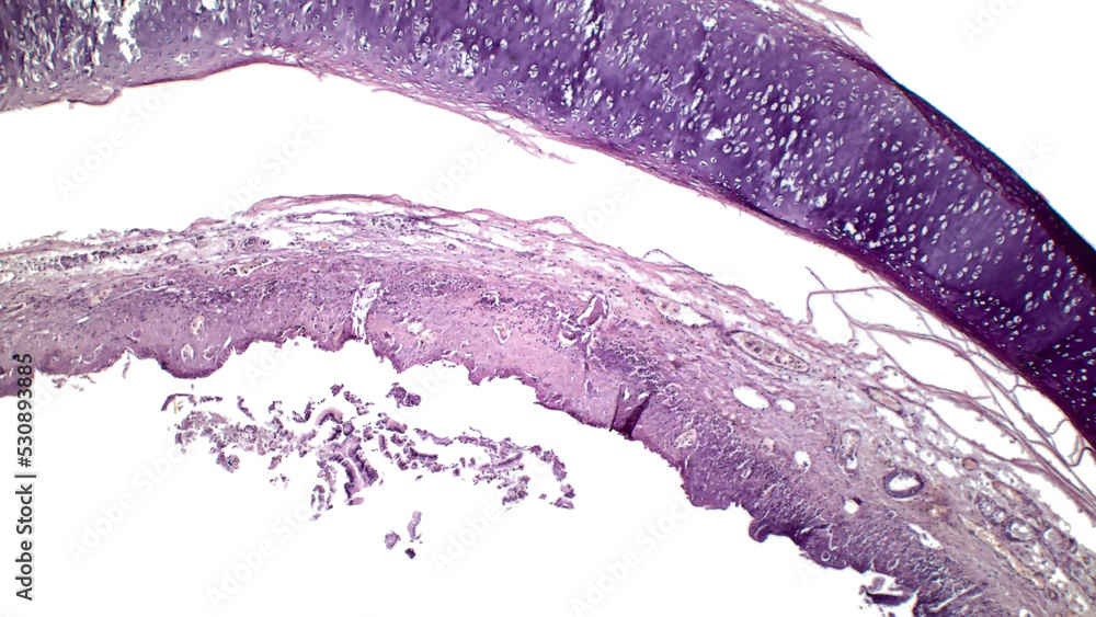 Bronchial histology (bronchial epithelium). Bronchitis. The Chronic ...