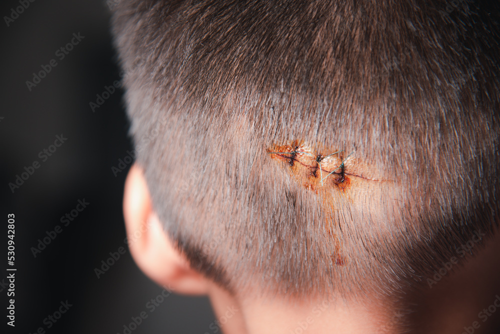 Stitches In Head