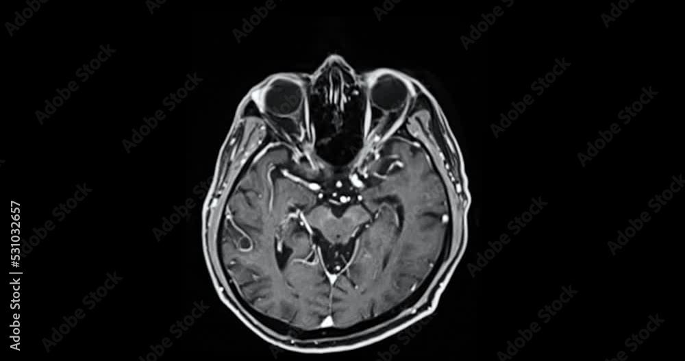 MRI of the brain with gadolinium contrast media for diagnosis brain ...