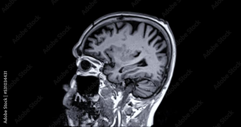 MRI of the brain with gadolinium contrast media for diagnosis brain ...