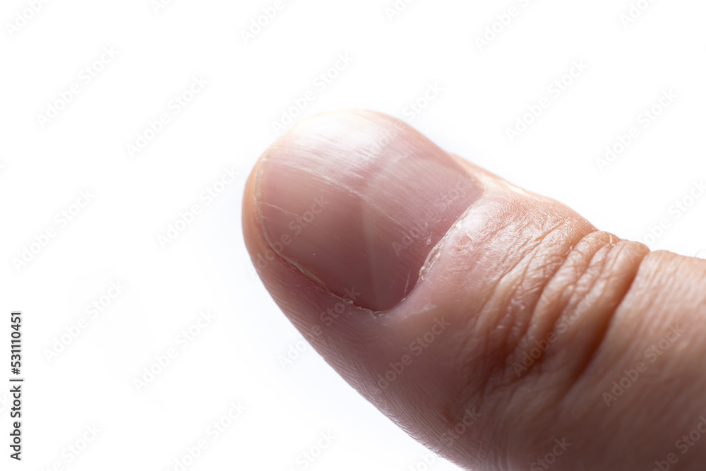 Ridged fingernail of a thumb finger of a man with vertical ridges on ...
