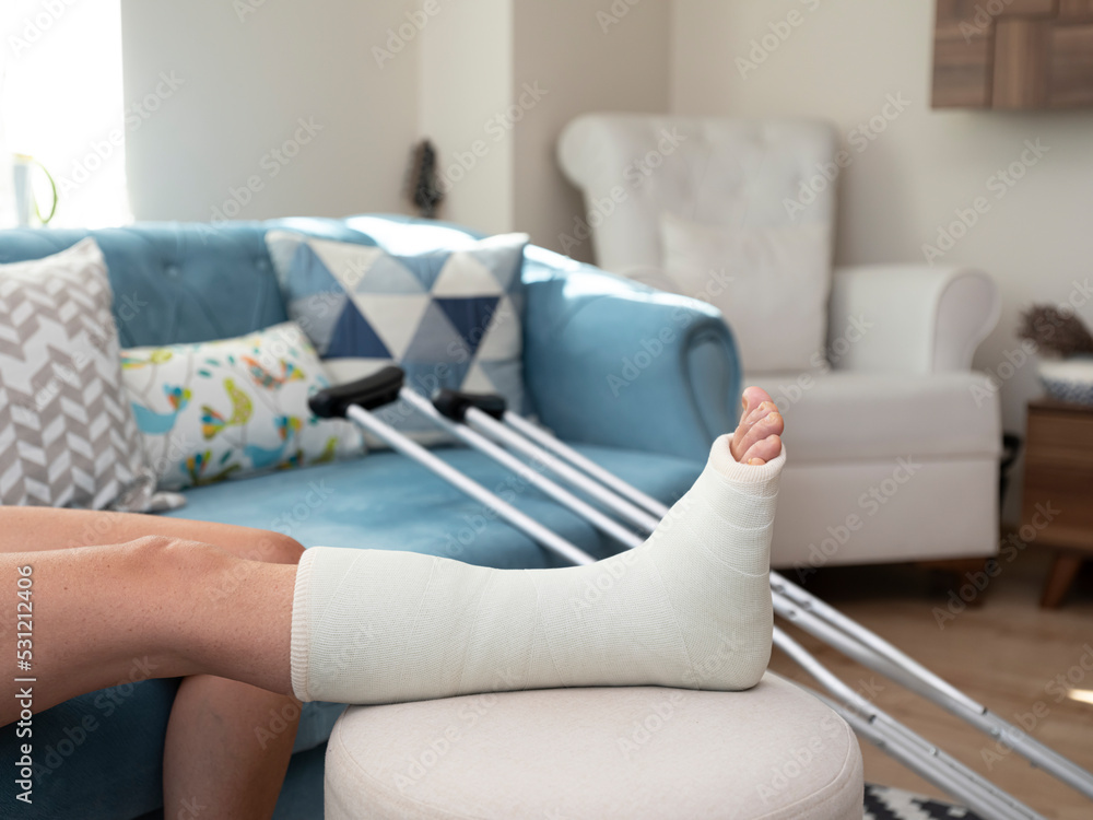 broken ankle and a leg cast. Leg splint Stock Photo | Adobe Stock