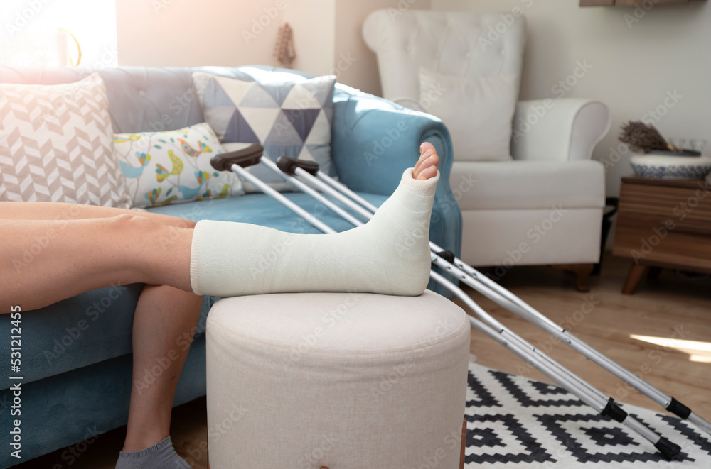 broken ankle and a leg cast. Leg splint Stock Photo | Adobe Stock