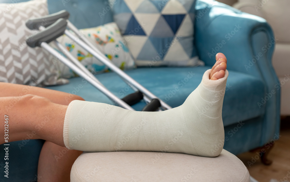 Foto de broken ankle and a leg cast. Leg splint do Stock | Adobe Stock