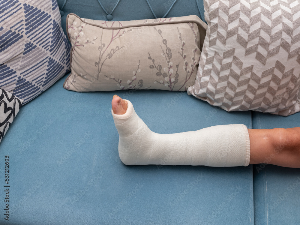 broken ankle and a leg cast. Leg splint Stock Photo | Adobe Stock