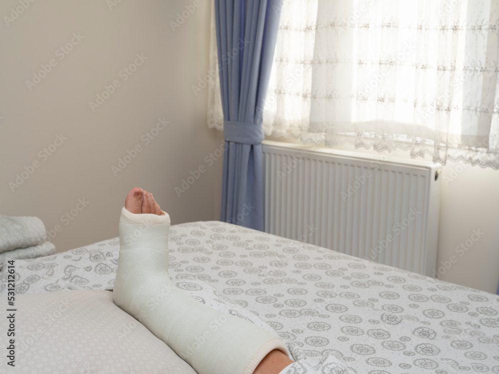 broken ankle and a leg cast. Leg splint Stock Photo | Adobe Stock