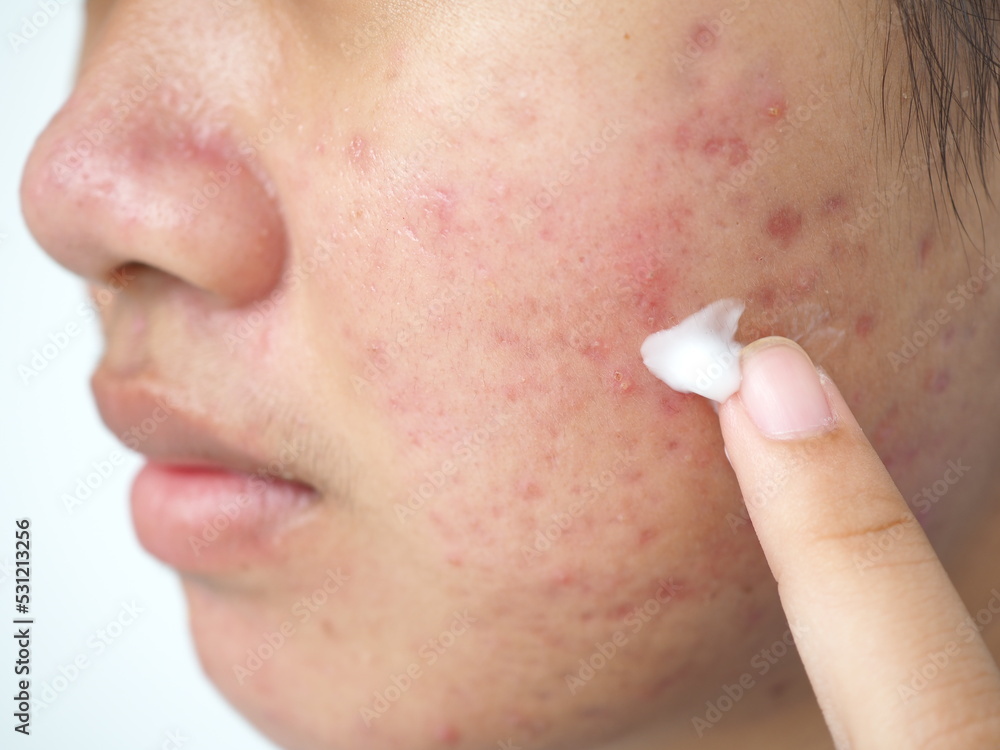 Teenager face with acne inflammation (Papule and Pustule) on her face ...