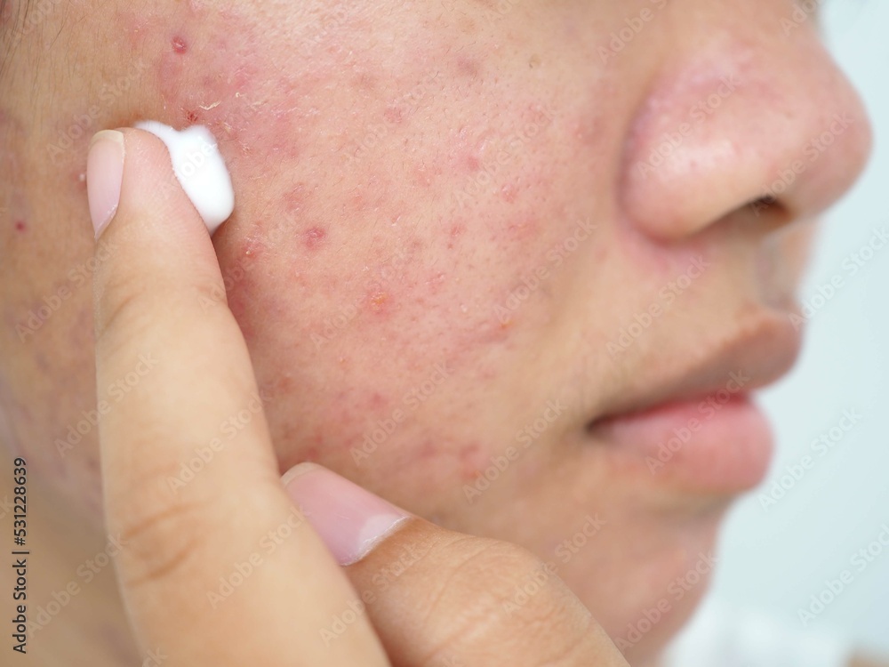 Woman face with acne inflammation (Papule and Pustule) on her face and ...